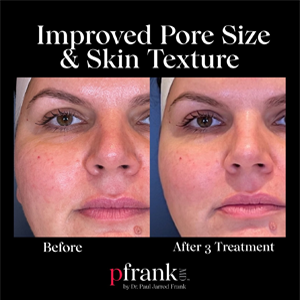 Vivace Ultra Treatment | PFRANKMD by Dr. Paul Jarrod Frank